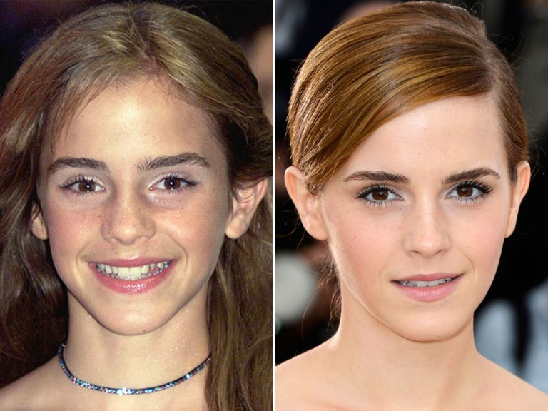 Celebrities With Veneers - Medic istanbul